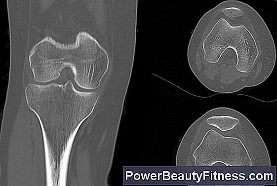 Tibia Plato Kırığı Için Egzersiz Programları 💪 Tüm Fitness Ve Sağlıklı ...